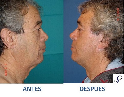 Pre y Post operatorio - Dr. Joan Pallares